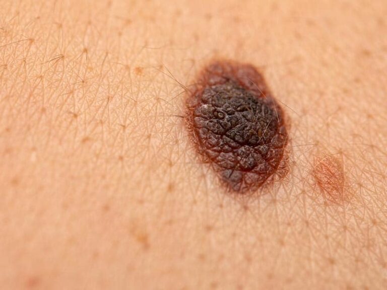 Moles - St Michaels Clinic