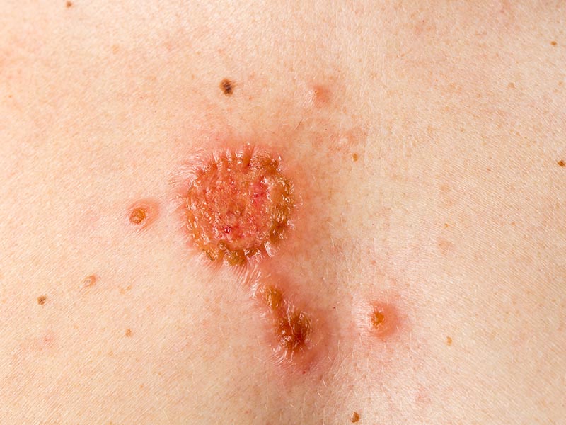 Skin Cancer Conditions St Michaels Clinic