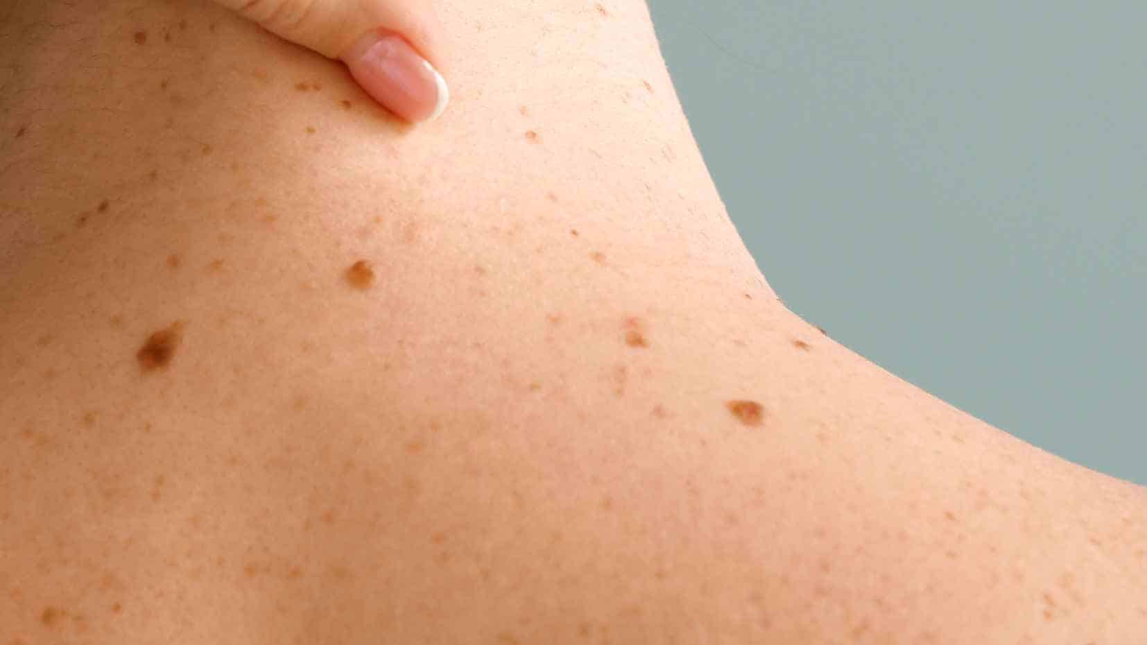 Dermatosis Papulosa Nigra - St Michaels Clinic